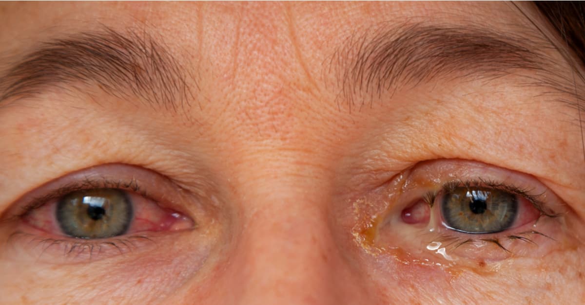 Viral Conjunctivitis - What it is and How to Treat it. - SCALAR LIGHT