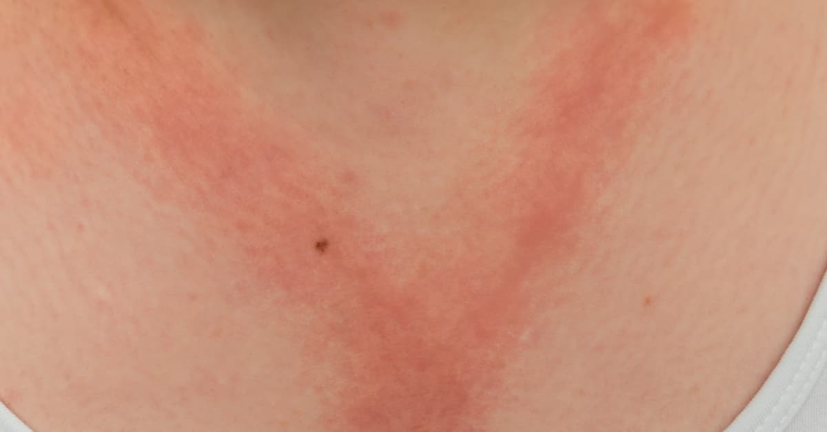 The Eight Different Types of Eczema - SCALAR LIGHT
